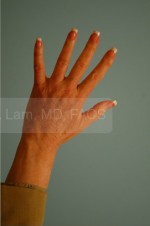 Dallas Hand Rejuvenation (with Fat Transfer) Before and After Photos ...