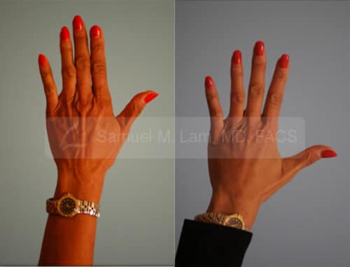 Dallas Hand Rejuvenation (with Fat Transfer) Before and After Photos ...