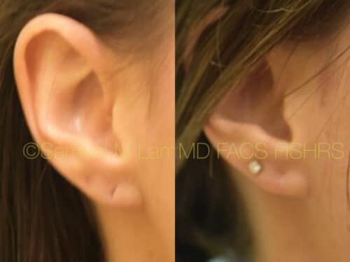 Dallas Torn Earlobe Repair Before and After Photos - Plano Plastic ...