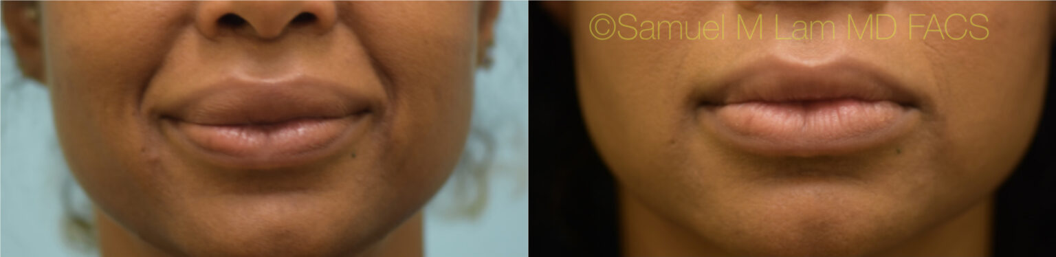 Dallas Lip Reduction (Corrective and Ethnic) Before and After Photos ...