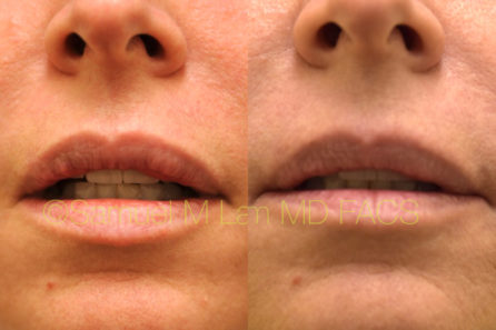 Dallas Lip Reduction (Corrective and Ethnic) Before and After Photos ...