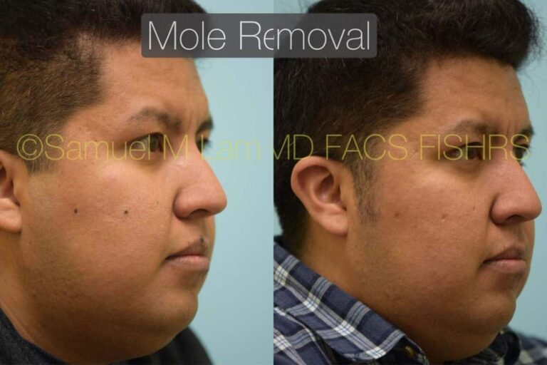 Dallas Mole Removal and Facial Excisions Before and After Photos ...