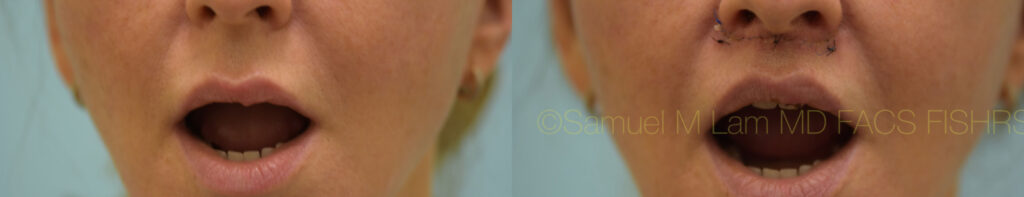 Dallas Lip Reduction (Corrective and Ethnic) Before and After Photos ...