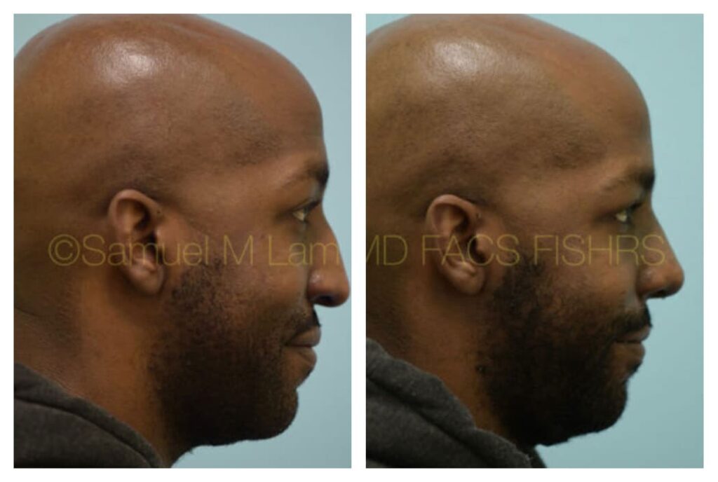 Dallas Lip Reduction (Corrective and Ethnic) Before and After Photos ...