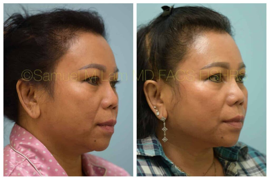 Dallas Revision/Corrective Rhinoplasty Before and After Photos - Plano ...