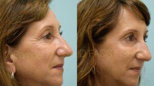 Dallas Botox Before and After Photos - Plano Plastic Surgery Photo ...