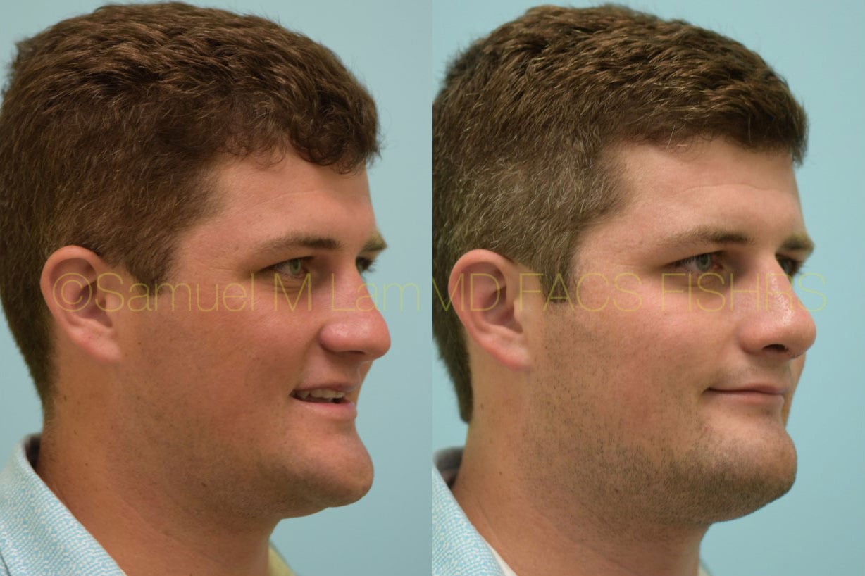 Dallas Revision/Corrective Rhinoplasty Before and After Photos - Plano ...