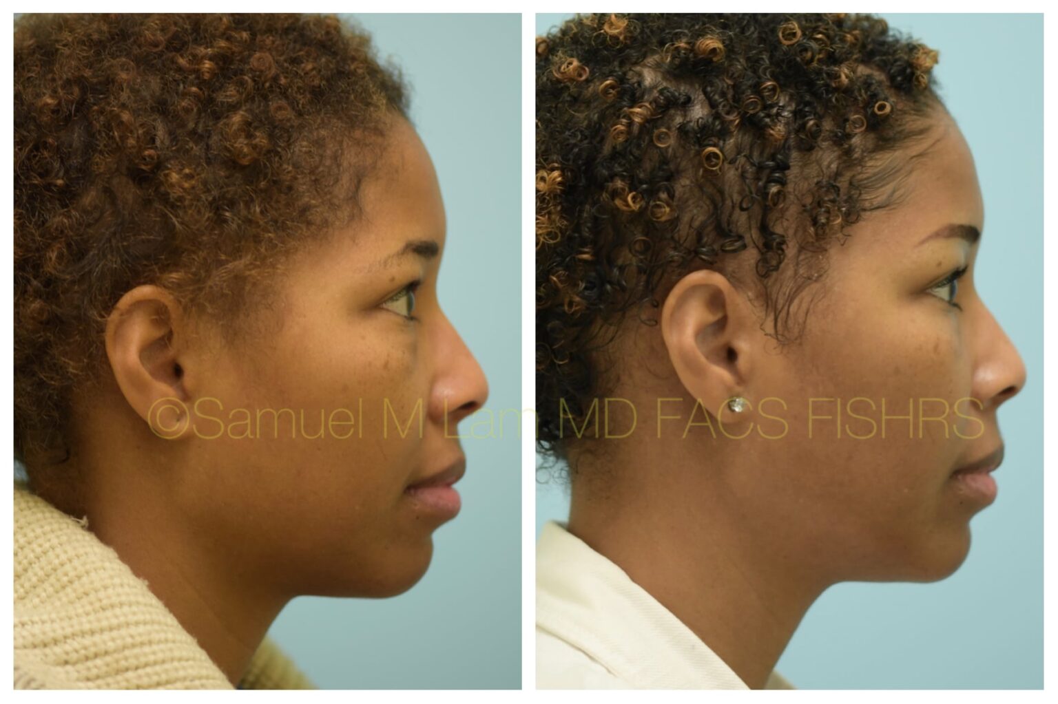 Dallas Fat Grafting Before and After Photos - Plano Plastic Surgery ...