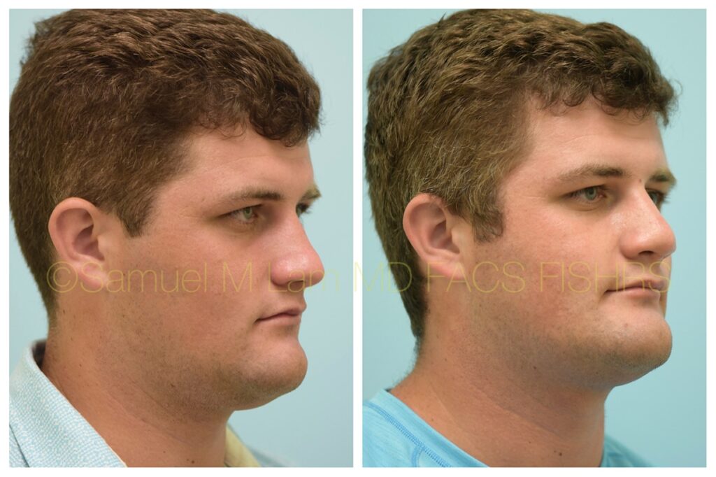 Dallas Revision/Corrective Rhinoplasty Before and After Photos - Plano ...