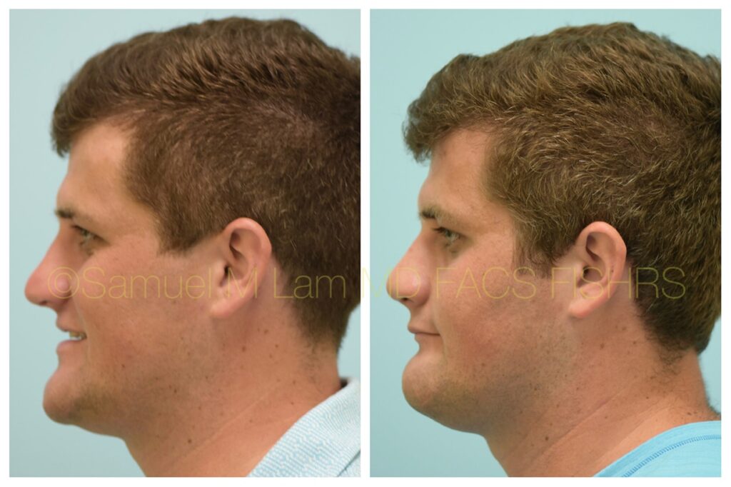 Dallas Revision/Corrective Rhinoplasty Before and After Photos - Plano ...
