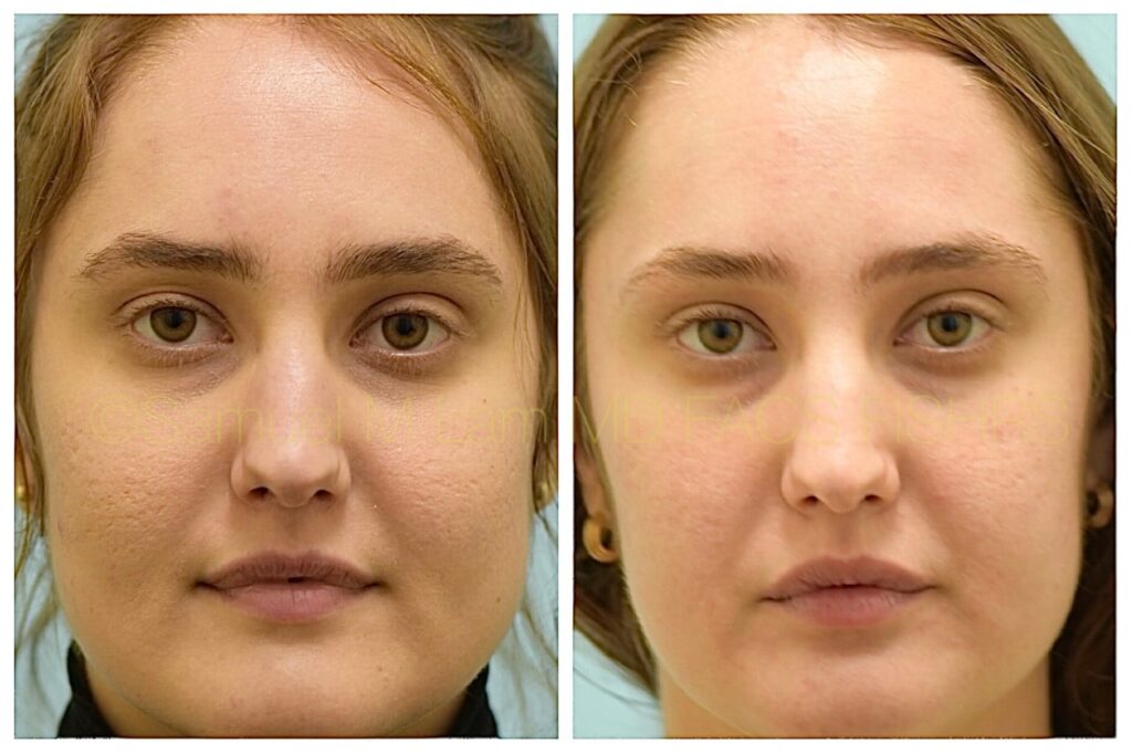 Dallas Acne Scarring Correction Before and After Photos - Plano Plastic ...