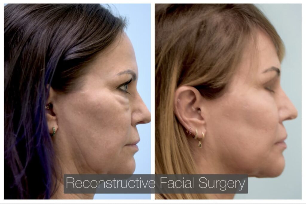 Dallas Scar Revision Before and After Photos - Plano Plastic Surgery ...