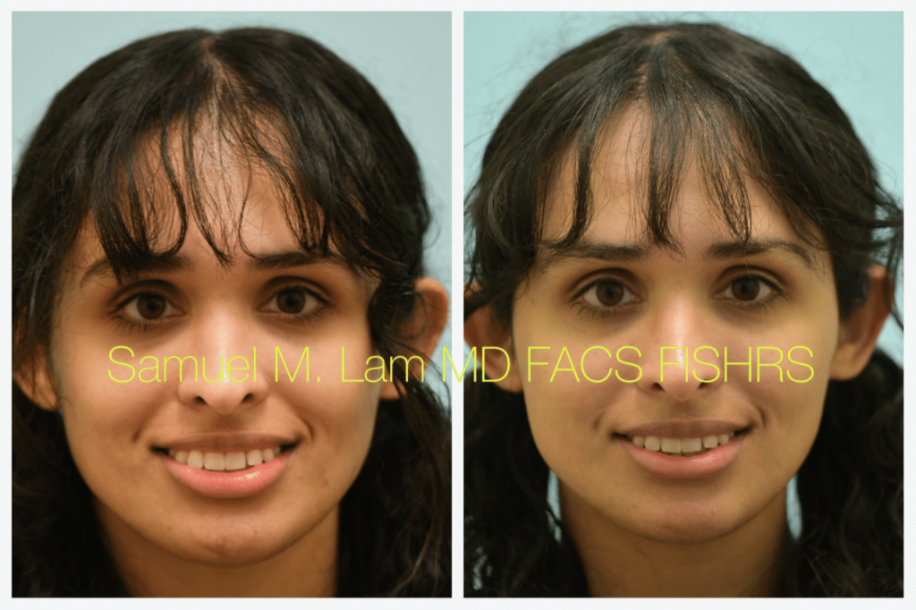 Dallas Lip Reduction (Corrective and Ethnic) Before and After Photos ...