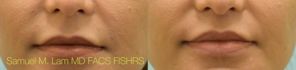Dallas Lip Lift Before and After Photos - Plano Plastic Surgery Photo ...