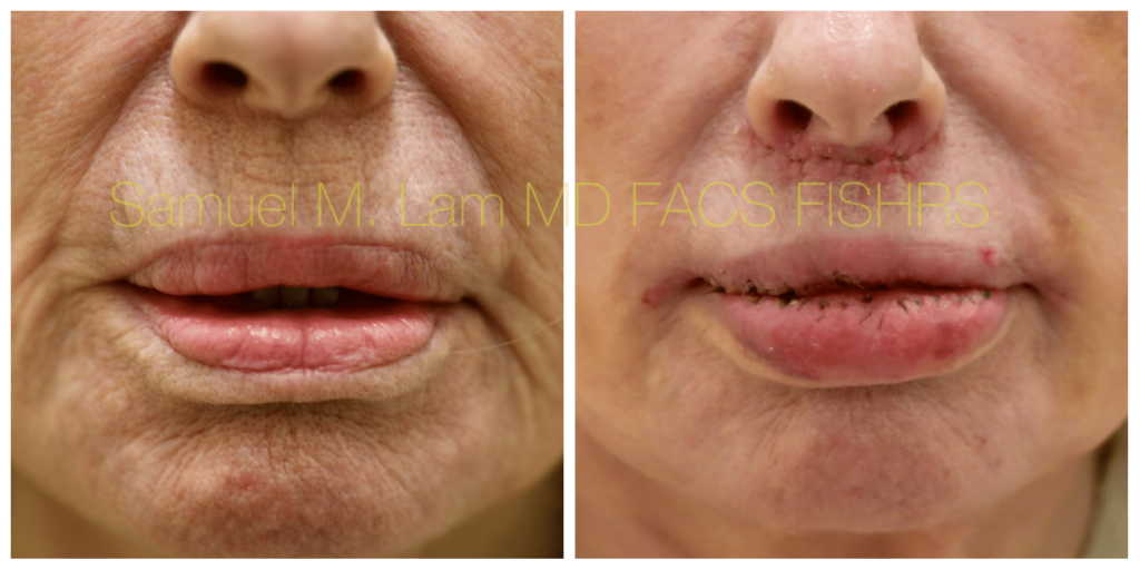 Dallas Lip Reduction (Corrective and Ethnic) Before and After Photos ...