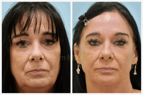 Dallas Botox Before and After Photos - Plano Plastic Surgery Photo ...