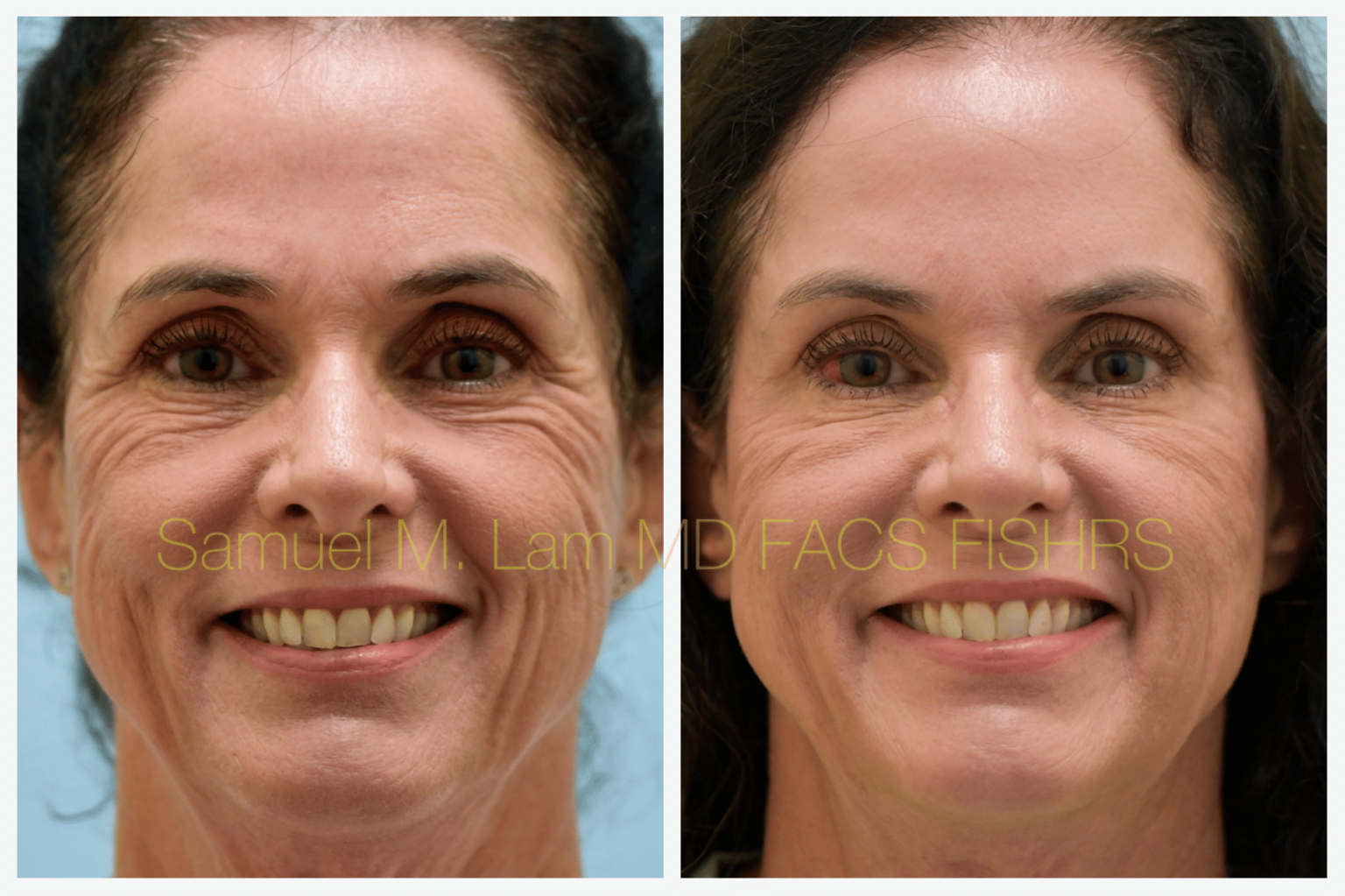 Dallas Botox Before and After Photos - Plano Plastic Surgery Photo ...