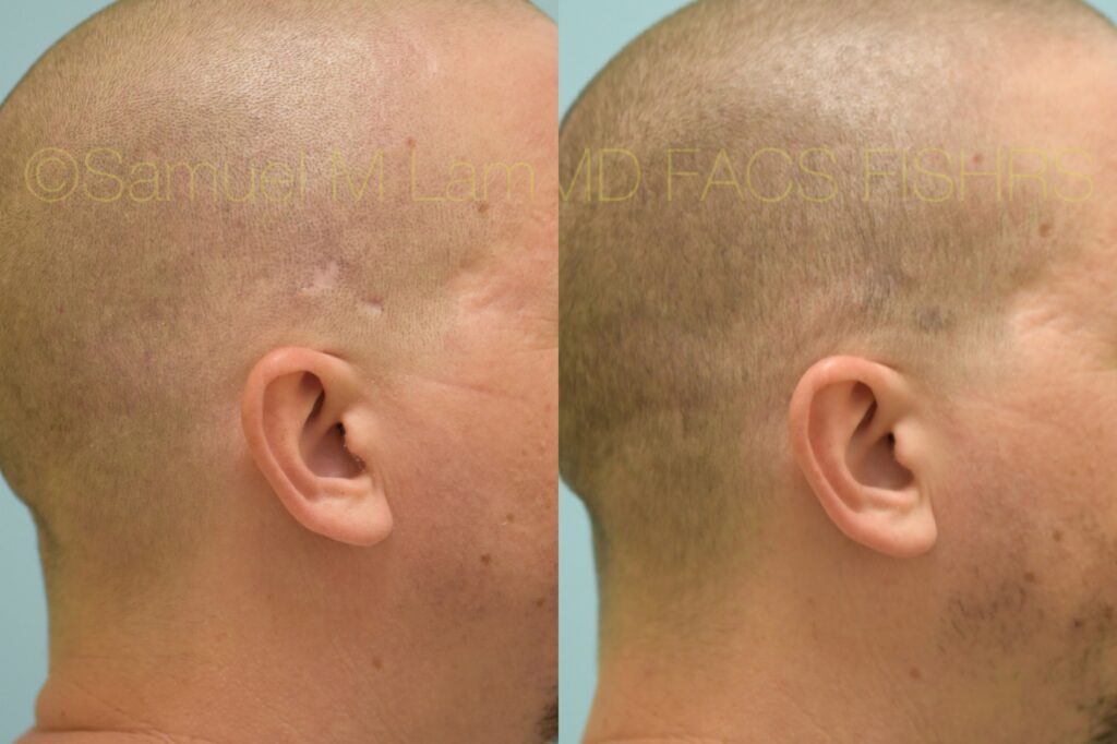 Dallas Scar Revision Before and After Photos - Plano Plastic Surgery ...