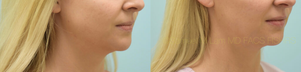 Dallas Botox Jaw Reduction Before and After Photos - Plano Plastic ...