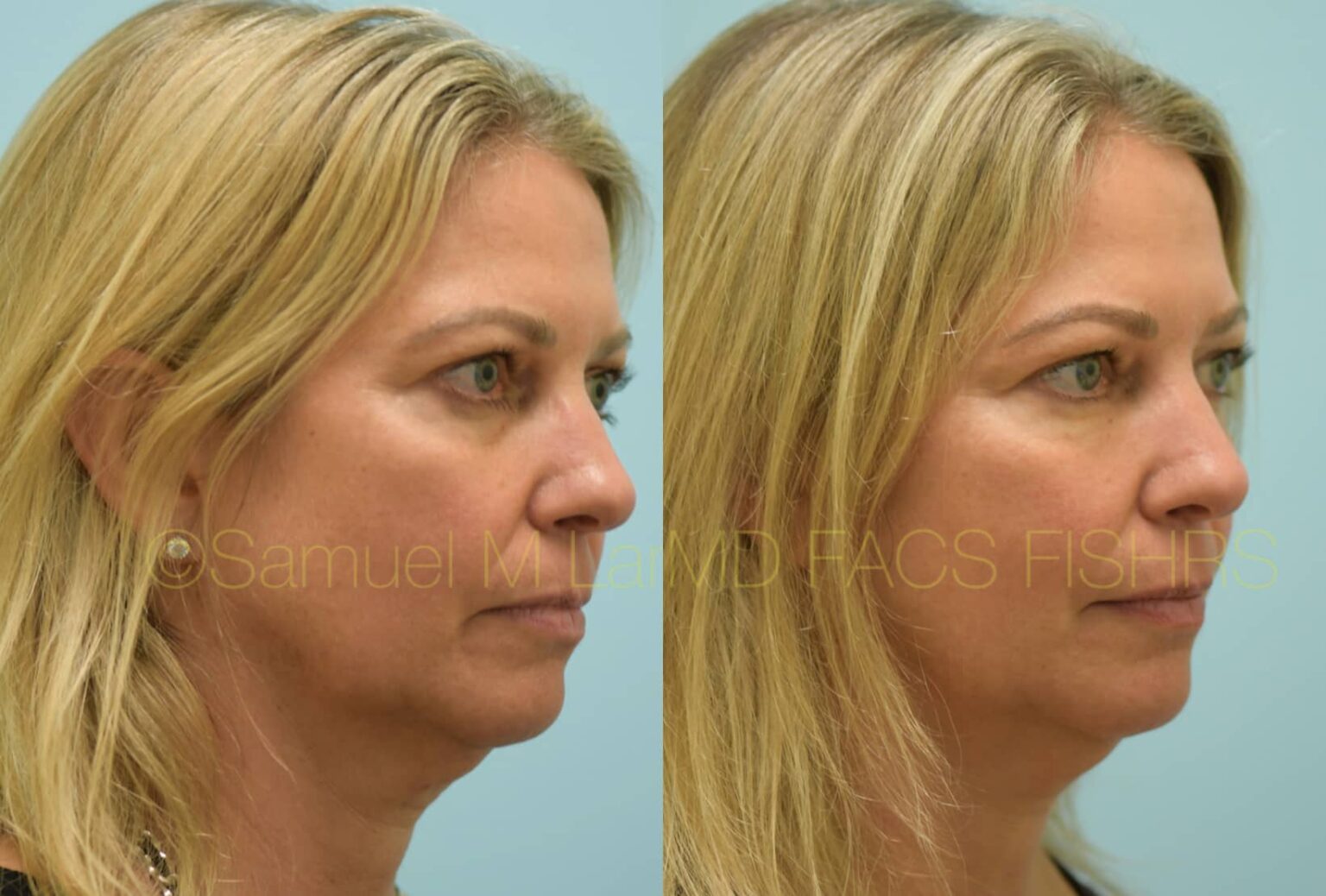 Botox : Before & After Photos