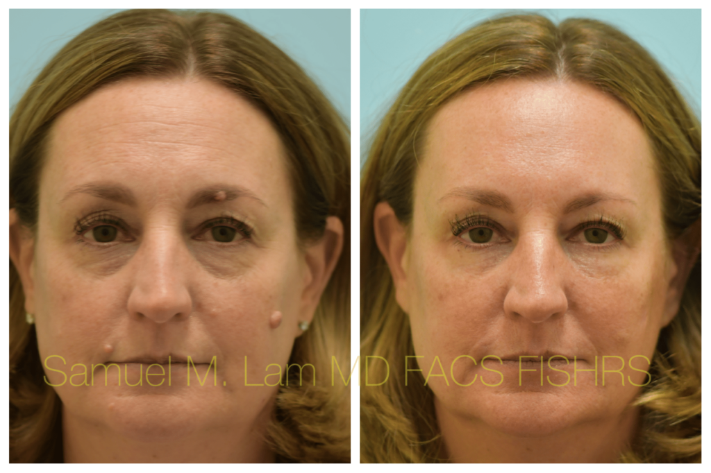Dallas Facial Plastic Surgeon Dr. Sam Lam‘s patient gives a testimonial ...