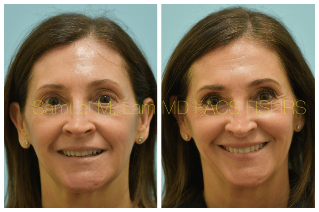 Dallas Lip Lift Before and After Photos - Plano Plastic Surgery Photo ...