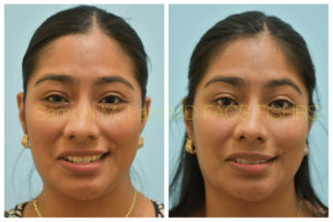 Dallas Botox Before and After Photos - Plano Plastic Surgery Photo ...