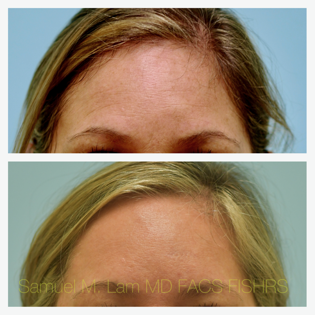 Osteoma Removal Archives | Lam, Sam (lamfacialplastics.com)