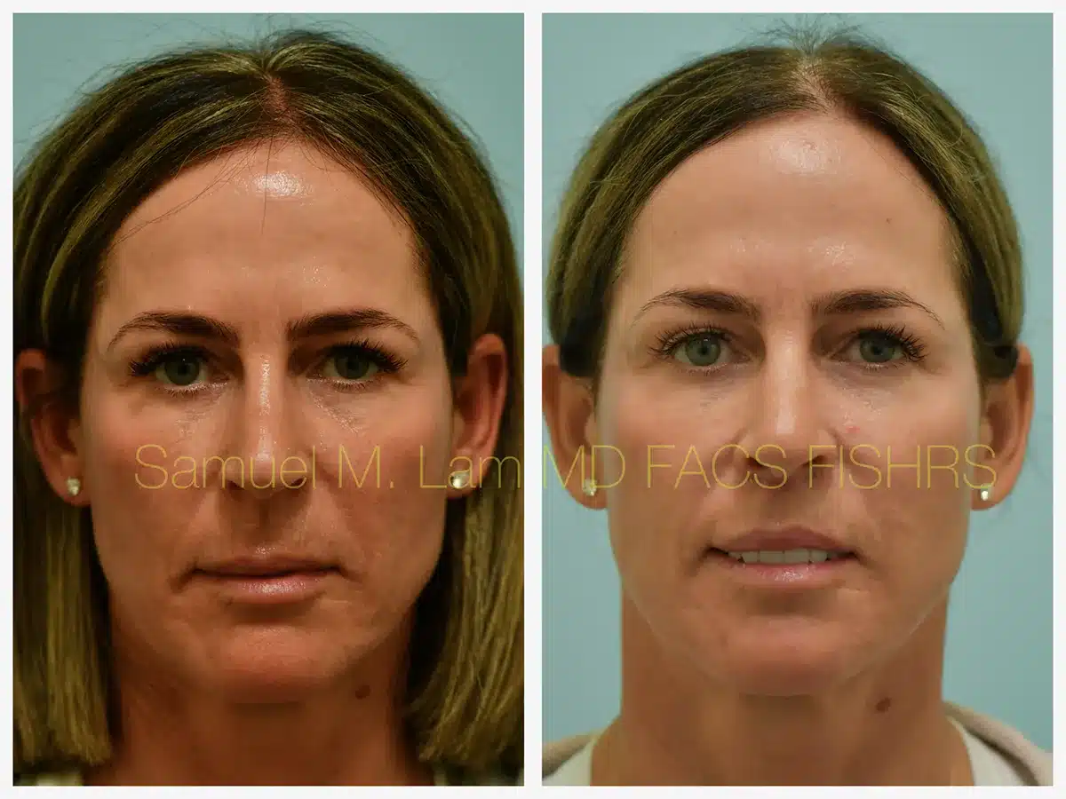 Lip Lift/Lip Advancement Photo Gallery | Lam Facial Plastics