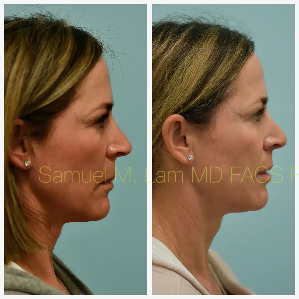 Lip Lift/Lip Advancement Photo Gallery | Lam Facial Plastics