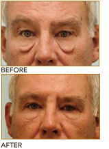 Malar Mound Reduction Dallas, Malar Reduction Plano, TX