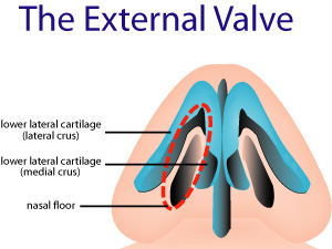 Rhinoplasty Tutorial Dallas | Nose Surgery Information Plano