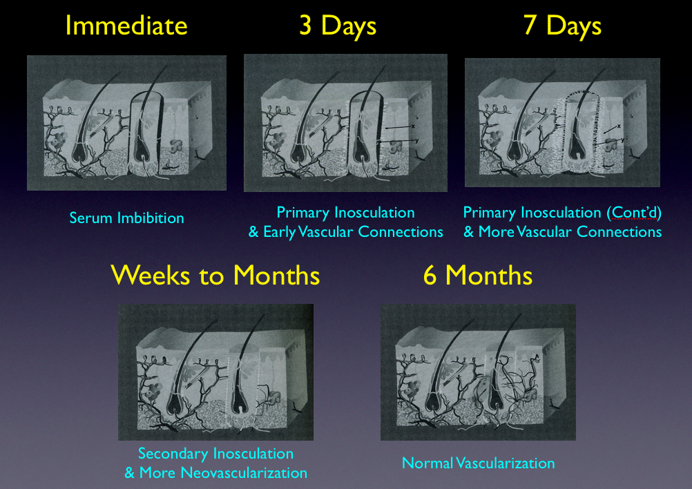 Fat Grafting Using a Hair Transplant Model for Understanding Part 1 ...